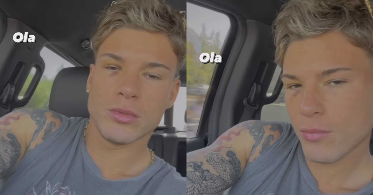 Raimundo Cerda reveló la razón por la que tiene moretones en su cara ...